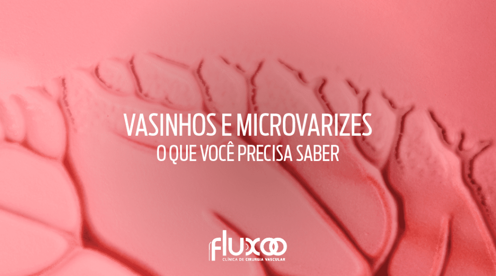 Vasinhos e microvarizes - o que você precisa saber.