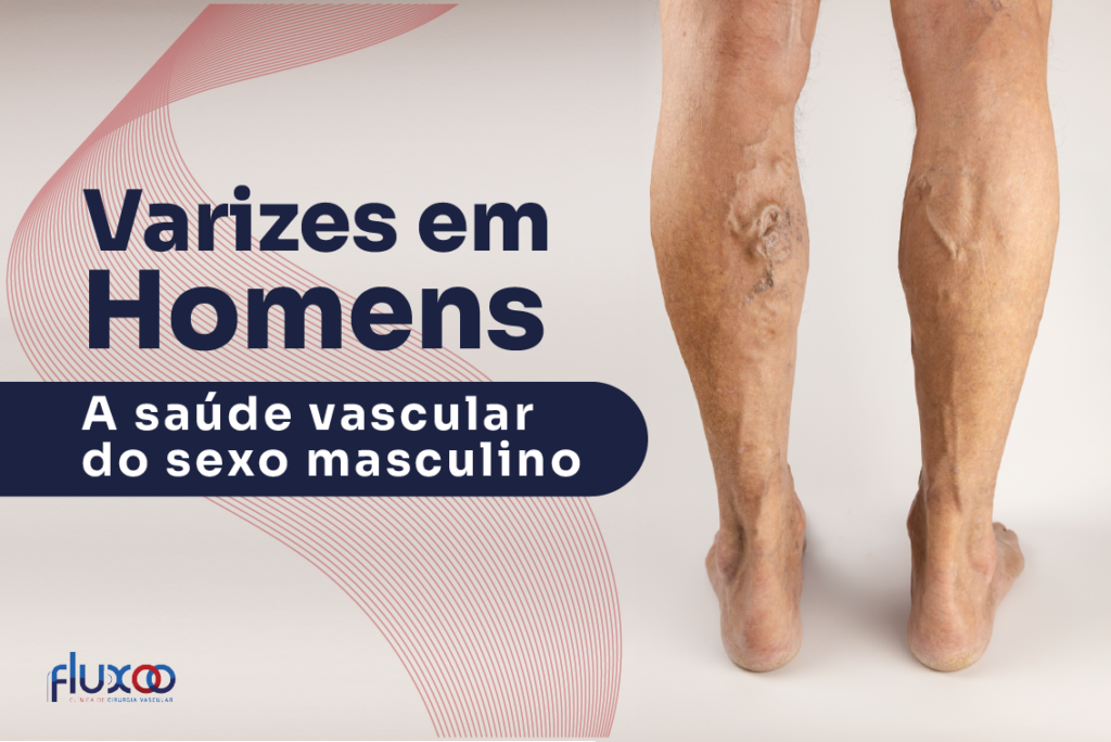 Varizes em Homens - A saúde vascular do sexo masculino