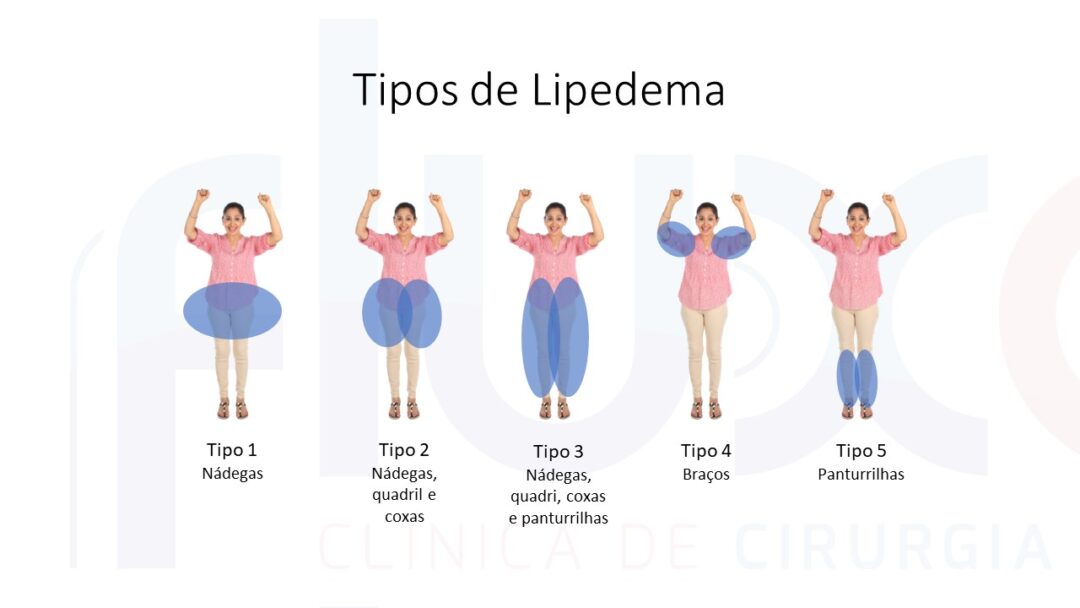 12 dúvidas sobre lipedema - Fluxo Clínica de Cirurgia Vascular