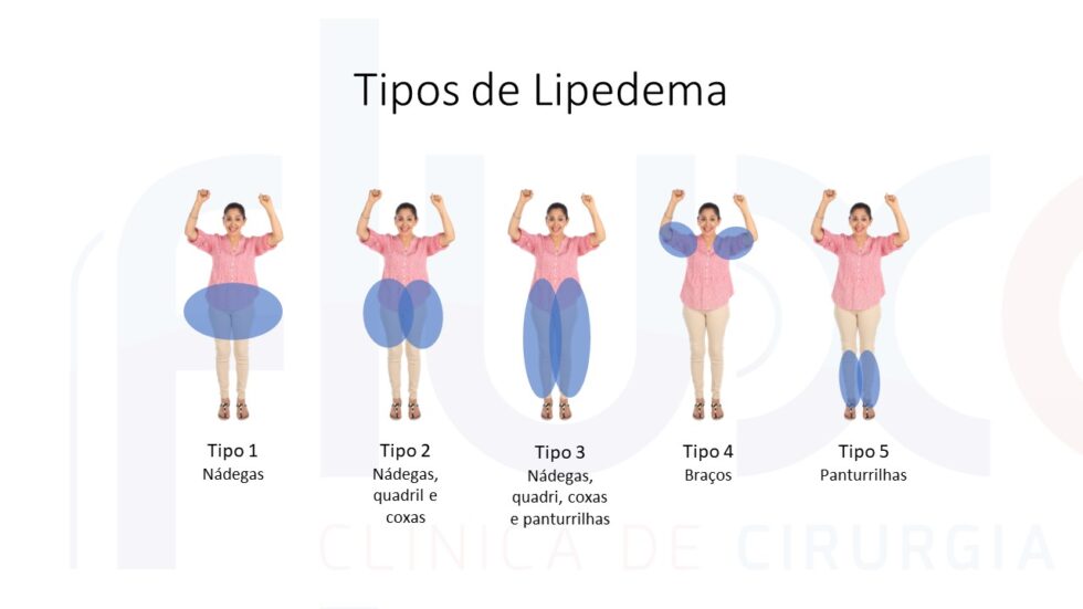 12 dúvidas sobre lipedema - Fluxo Clínica de Cirurgia Vascular