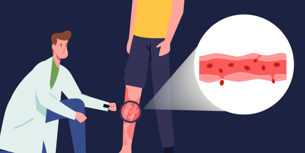 Vasculite: entenda como identificar a doença | Fluxo - Clínica de ...