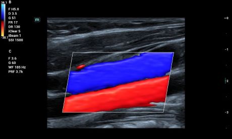 Varizes: O Poder do Ultrassom Doppler Venoso no Diagnóstico e Tratamento